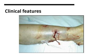 Tibia Fracture classification and management | PPTX