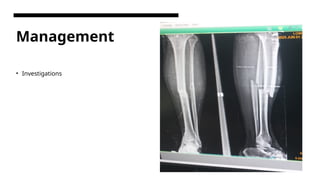 Tibia Fracture classification and management | PPTX