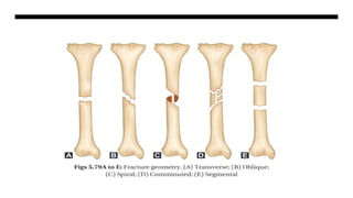 Tibia Fracture classification and management | PPTX