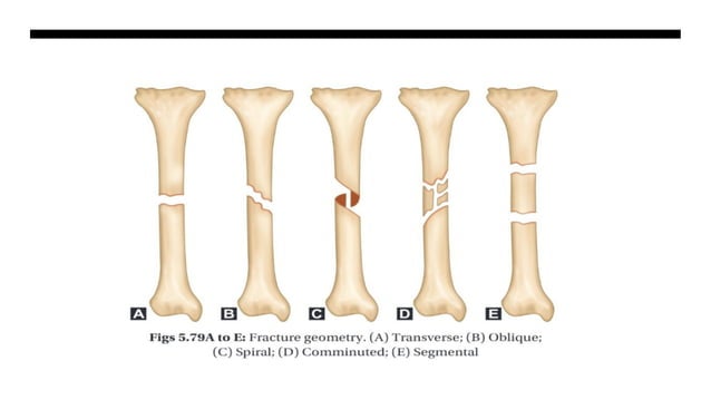 Tibia Fracture classification and management | PPTX