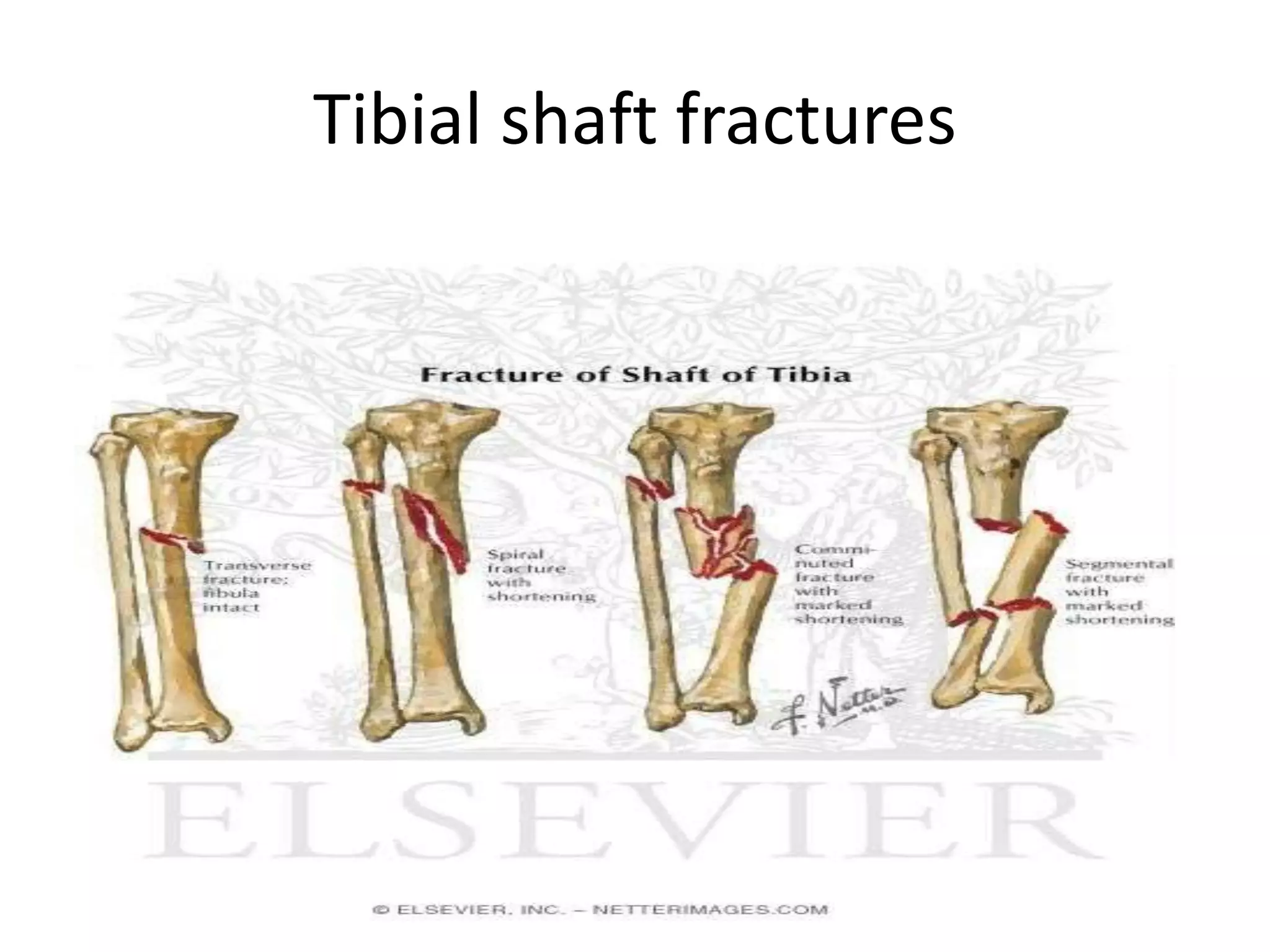 Tibia fractures | PPTX