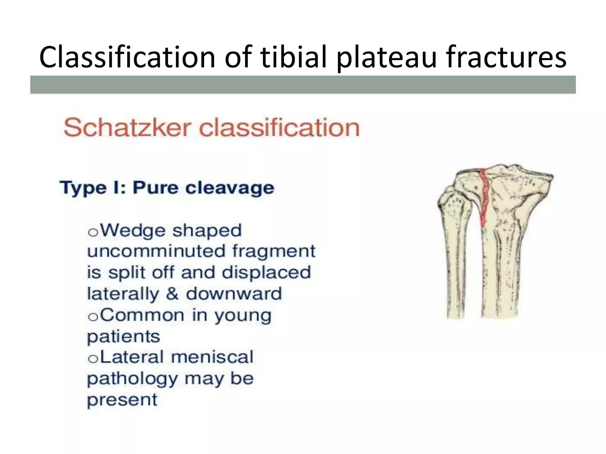 Tibia fractures | PPTX