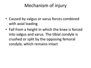 Tibia fractures | PPTX | Death, Injury, or Military Conflict ...