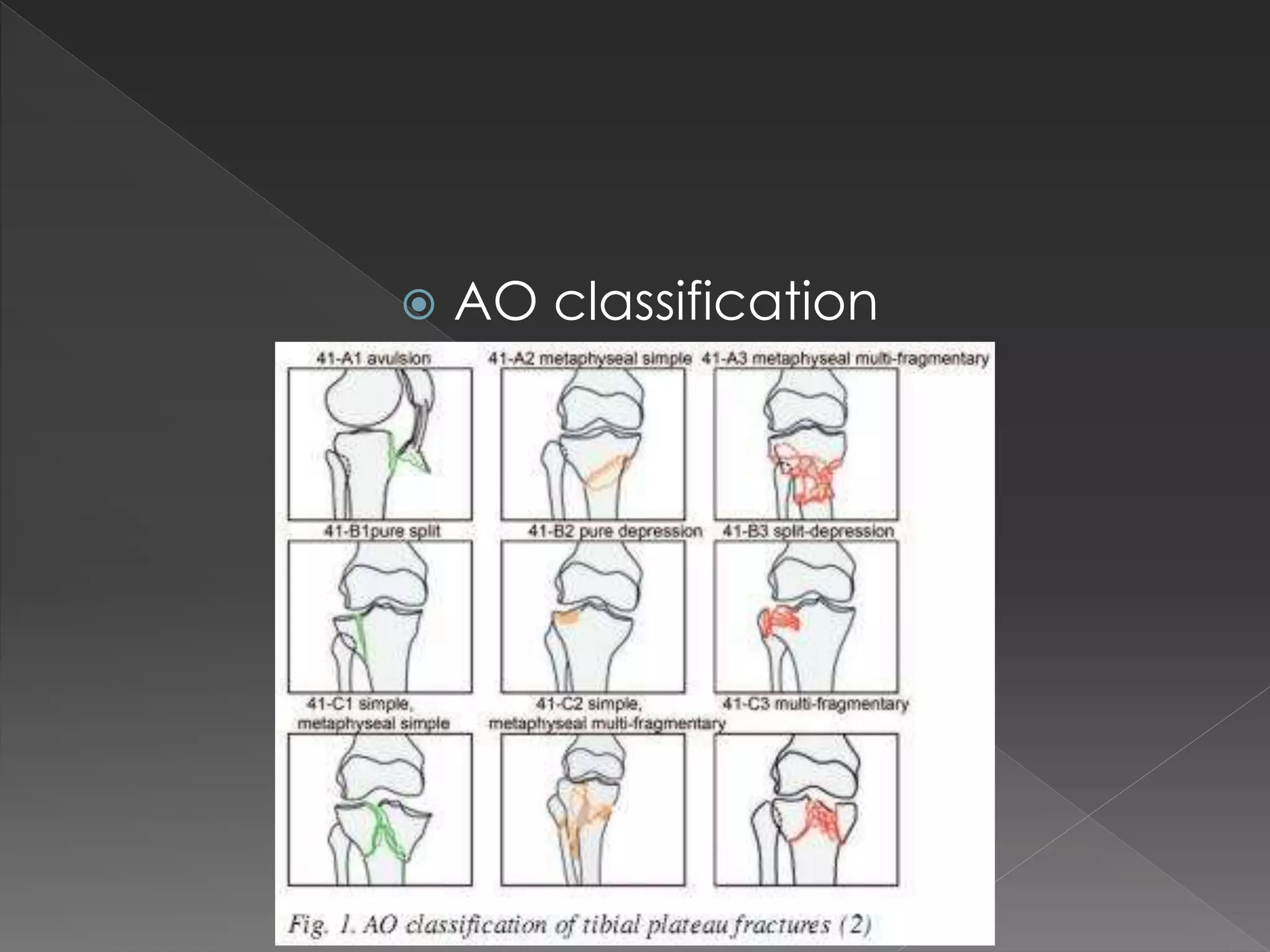 Tibial condyle fractures | PPTX