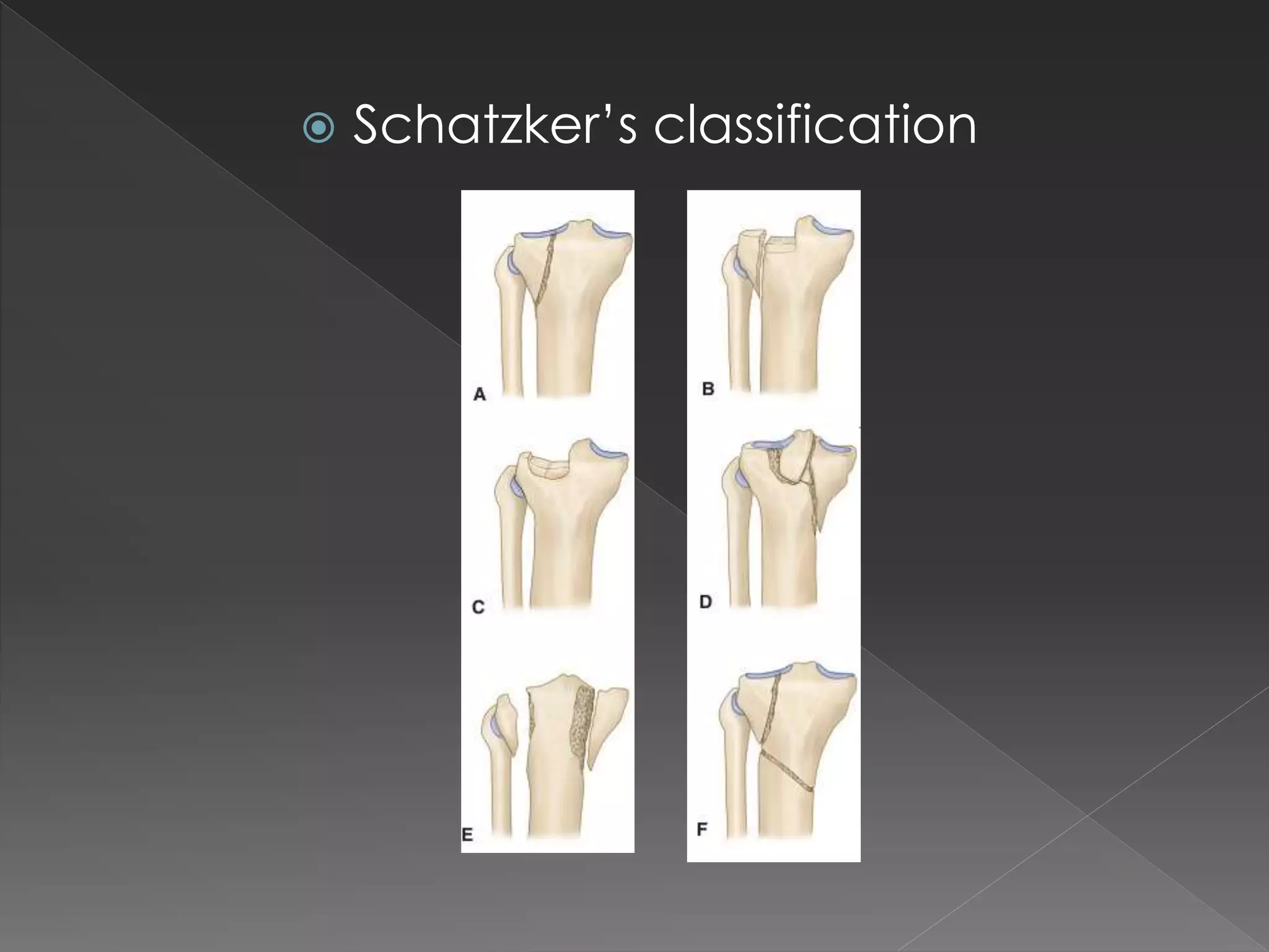 Tibial condyle fractures | PPTX