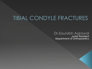 Tibial condyle fractures | PPTX