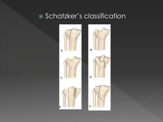 Tibial condyle fractures | PPTX