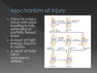 Tibial condyle fractures | PPTX