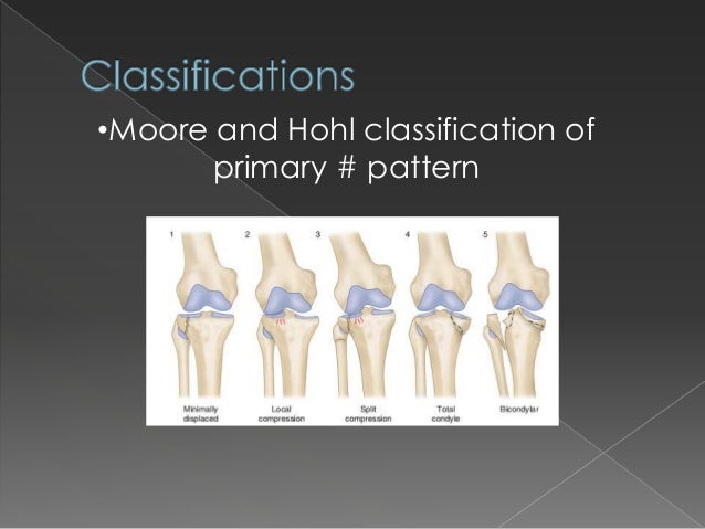 Tibial condyle fractures