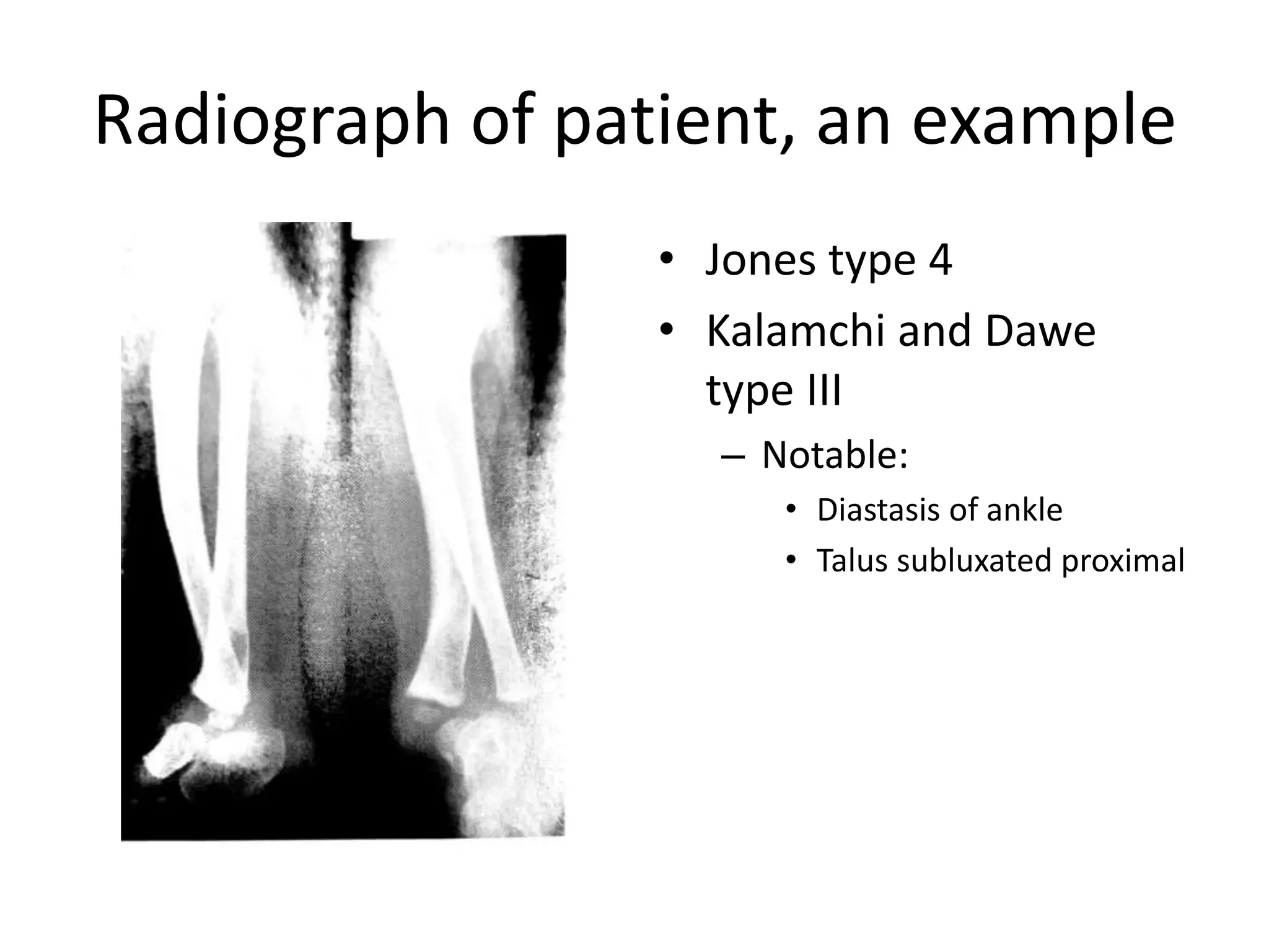 Tibial deficiency and Prosthetic management (part 1).pptx