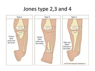 Tibial deficiency and Prosthetic management (part 1).pptx