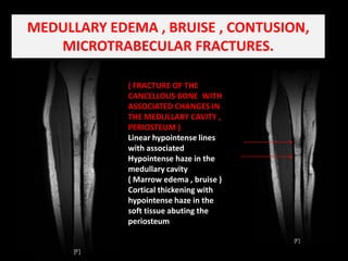 Tibial fracture | PPTX