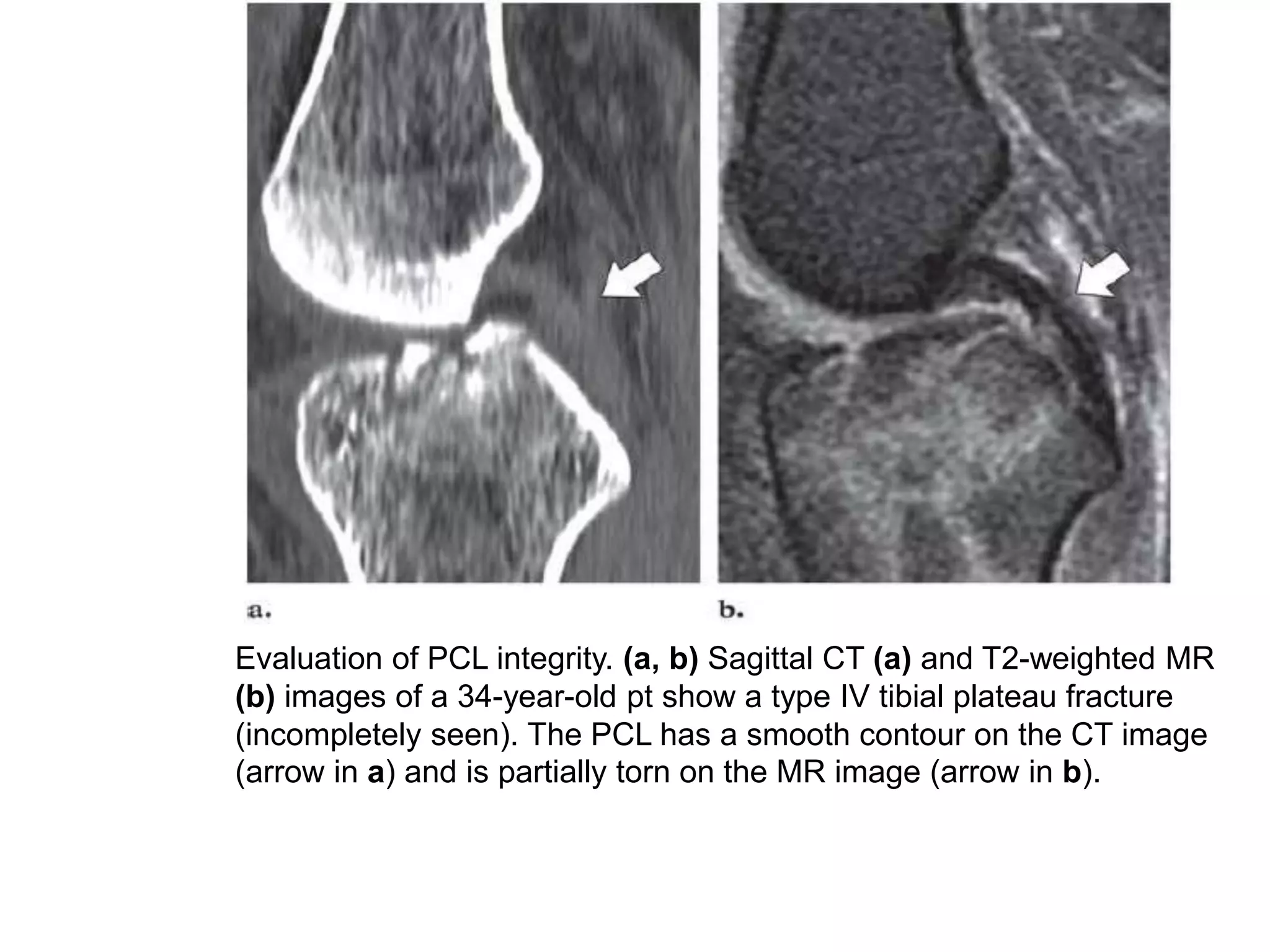 MRI in Tibial Fractures | PPTX