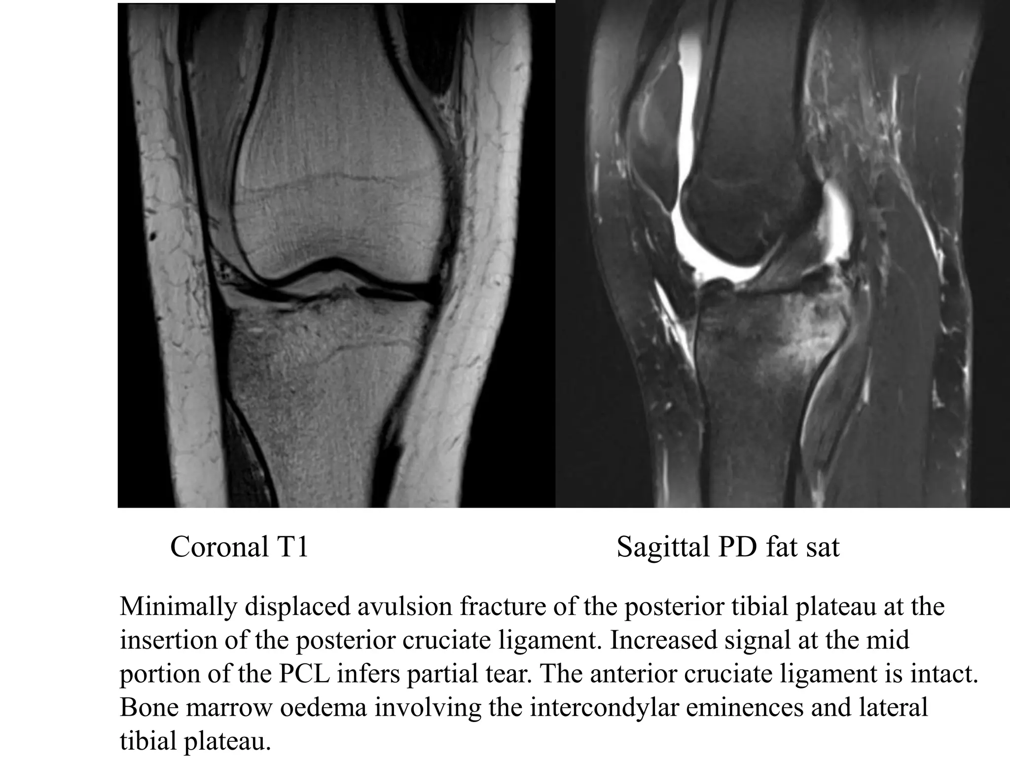 MRI in Tibial Fractures | PPT