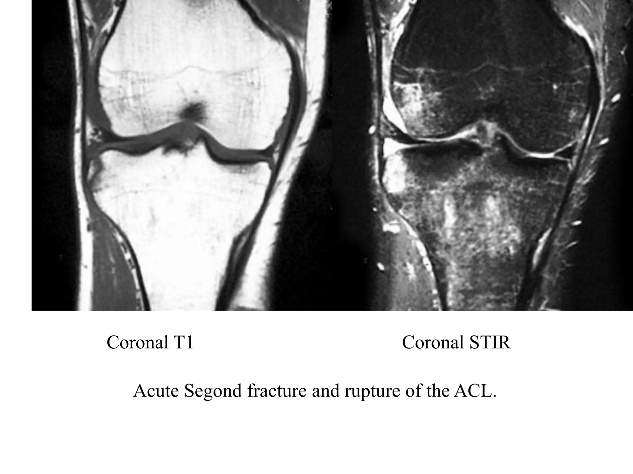 MRI in Tibial Fractures | PPTX