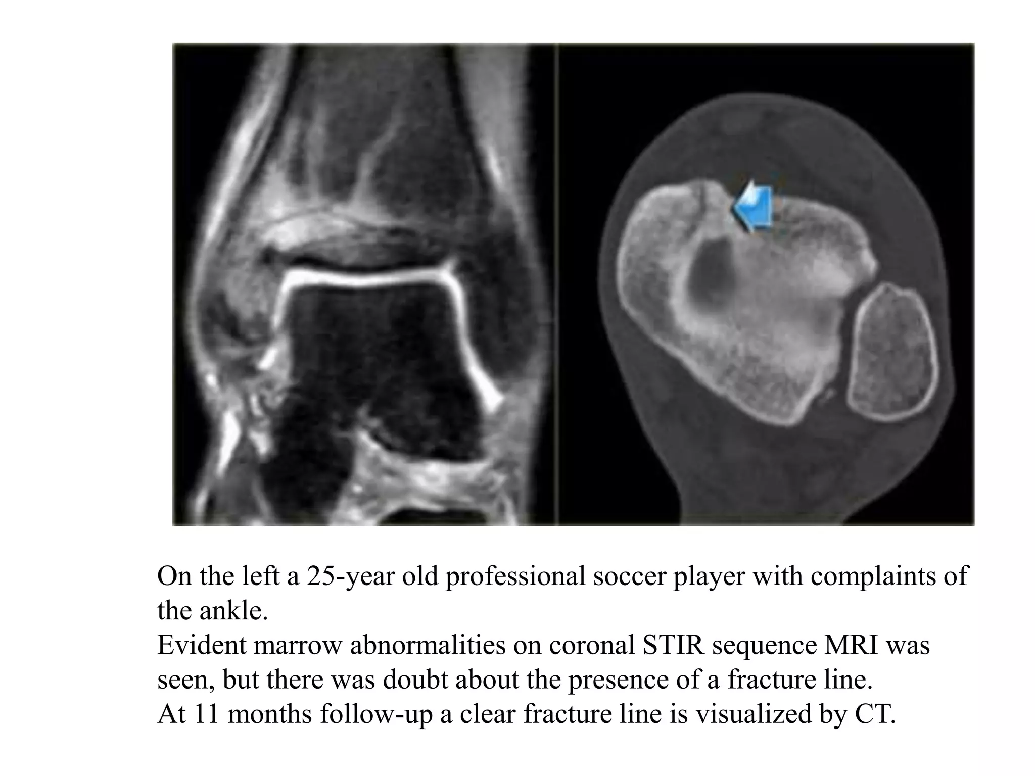 MRI in Tibial Fractures | PPTX
