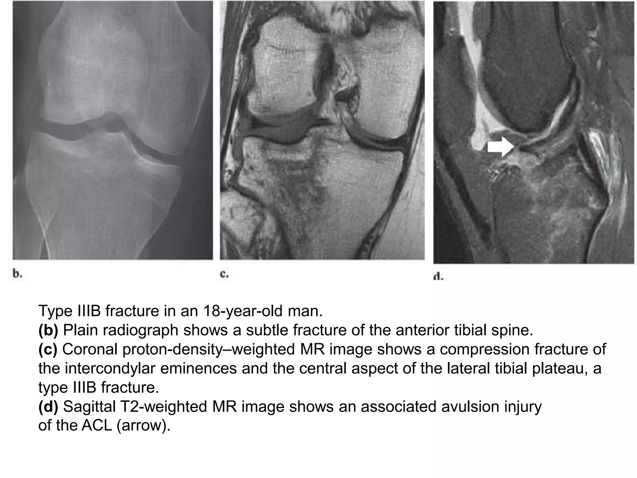 MRI in Tibial Fractures | PPT