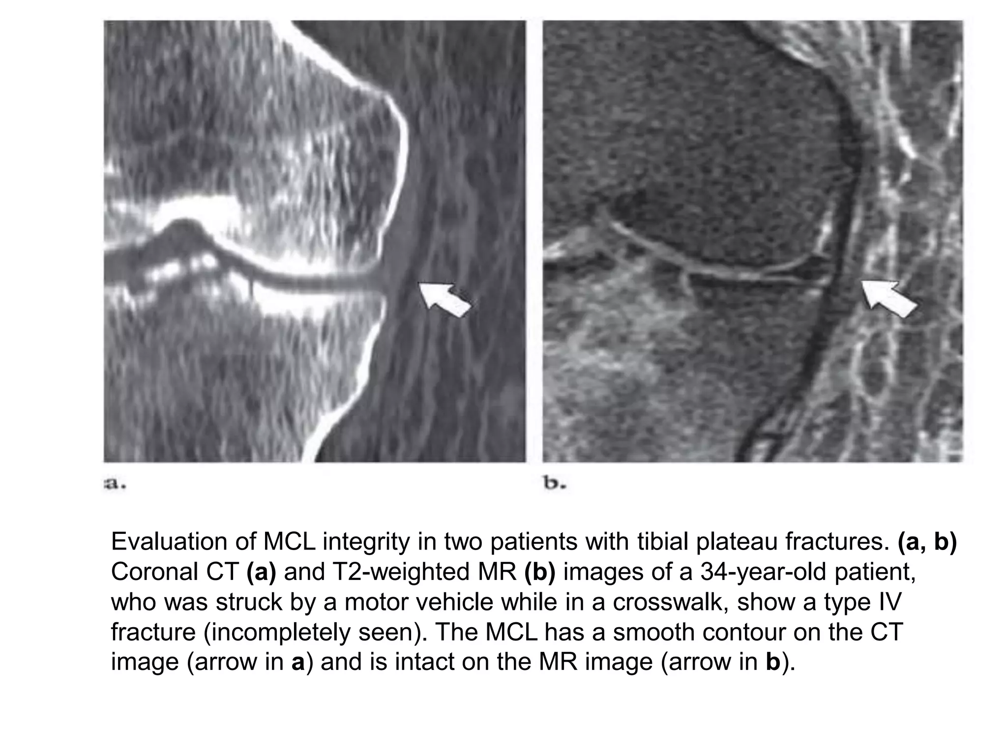 MRI in Tibial Fractures | PPTX