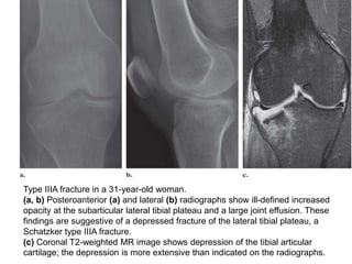 MRI in Tibial Fractures | PPTX