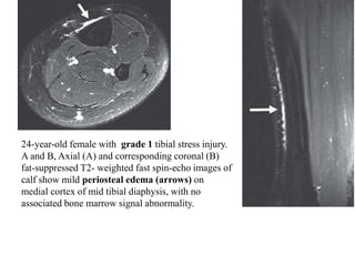Medial Tibial Stress Syndrome Mri
