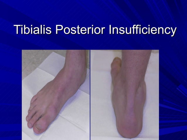 Tibialis posterior insufficiency | PPT