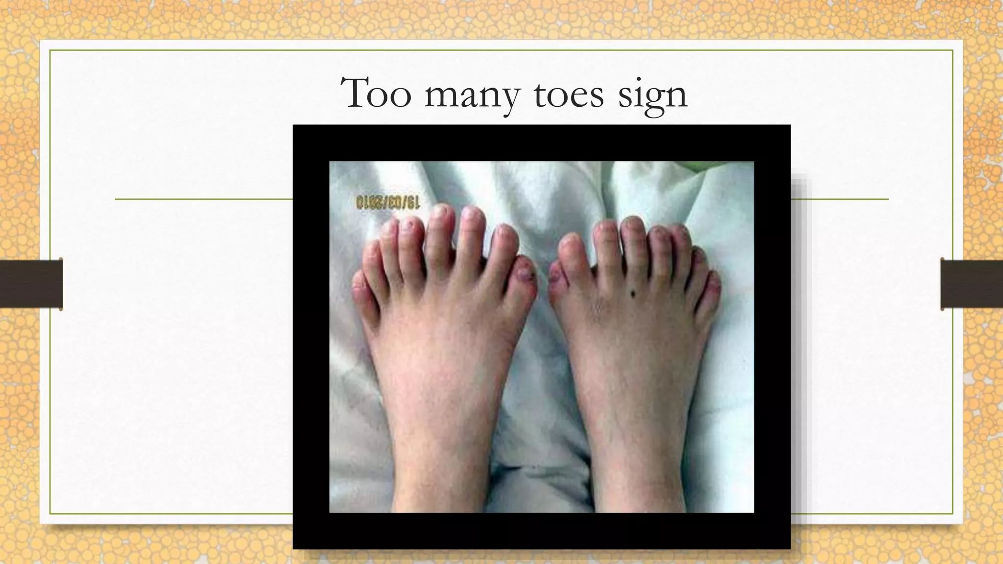 Tibialis Posterior Insufficiency.pptx