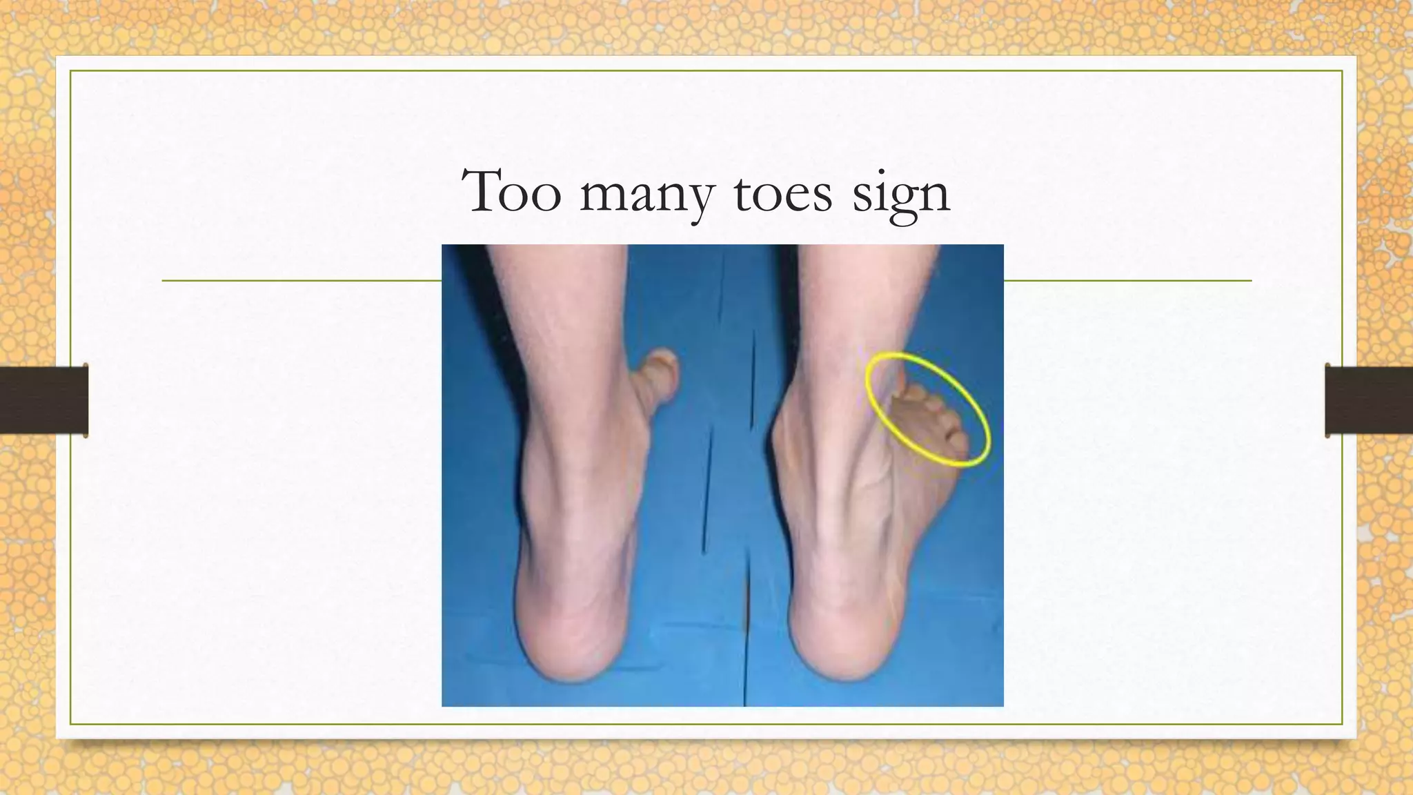 Tibialis Posterior Insufficiency.pptx