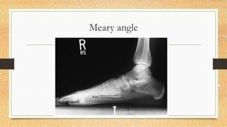Tibialis Posterior Insufficiency.pptx