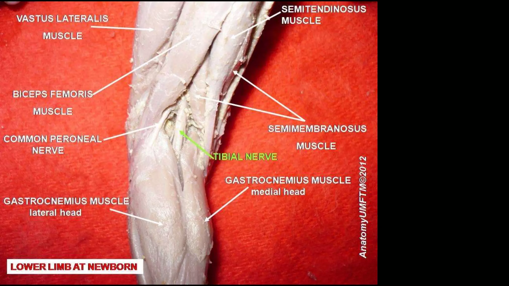 Tibial nerve Shreevarshni Lakshmikanthan .pptx