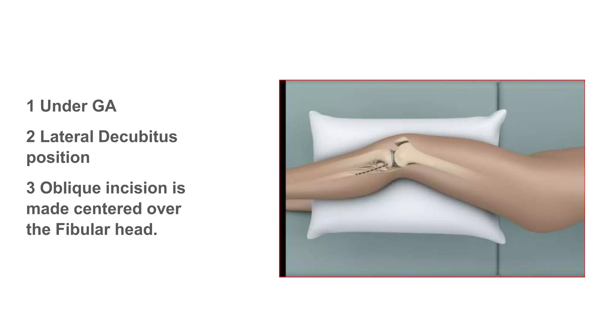 Tibial Nerve to Tibialis Anterior Motor branch of Deep Peroneal nerve ...