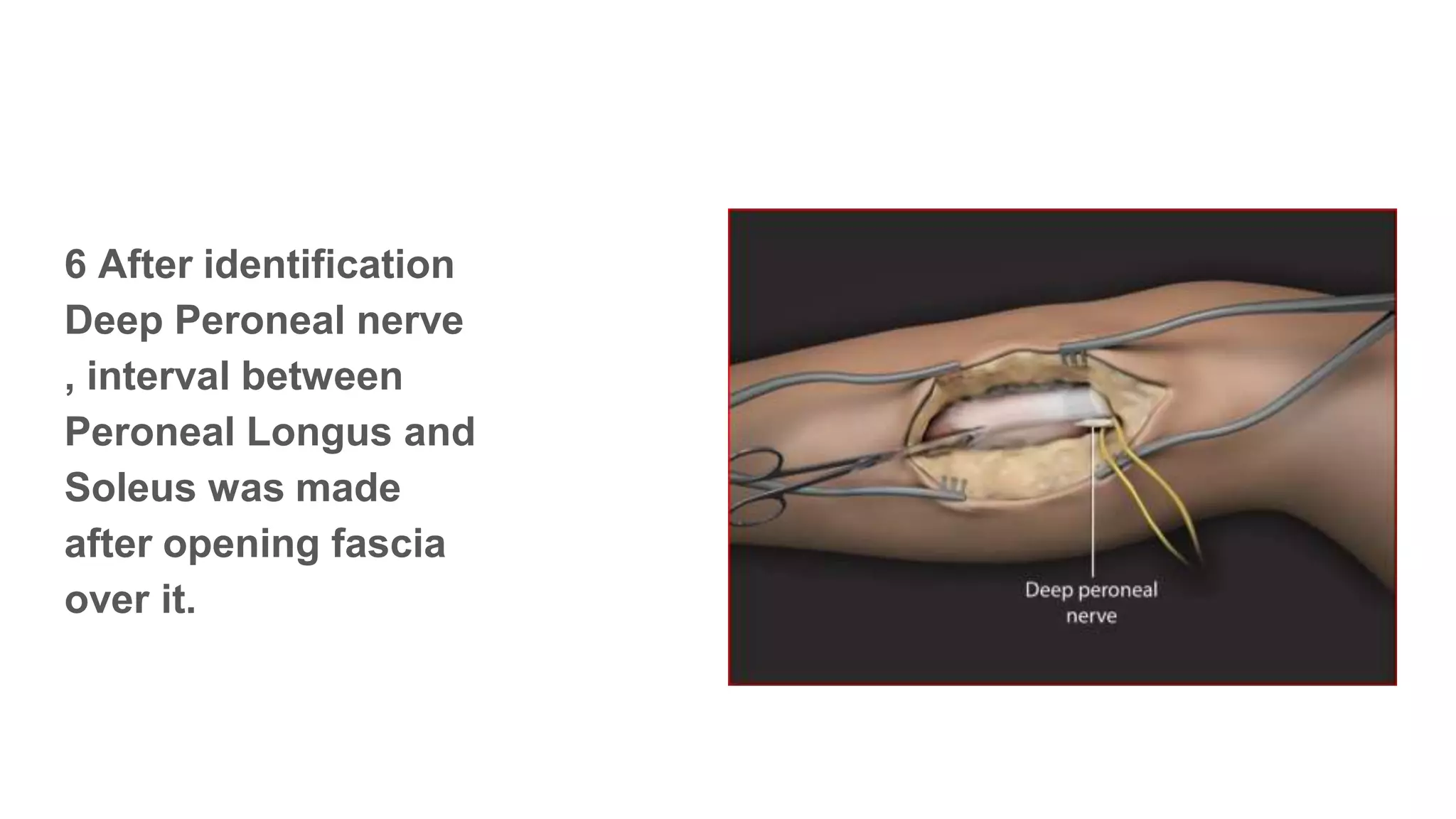 Tibial Nerve to Tibialis Anterior Motor branch of Deep Peroneal nerve ...