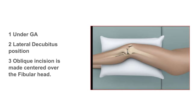 Tibial Nerve to Tibialis Anterior Motor branch of Deep Peroneal nerve ...