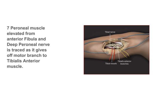 Tibial Nerve to Tibialis Anterior Motor branch of Deep Peroneal nerve ...