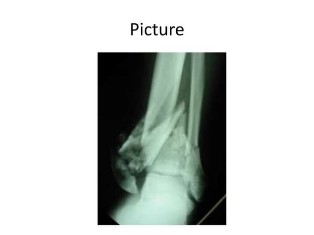 Tibial Plafond Fractures (1).pptx