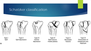 Tibial plateau fracture | PDF