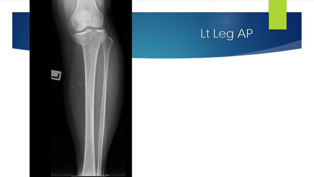 Tibial plateau fracture | PDF