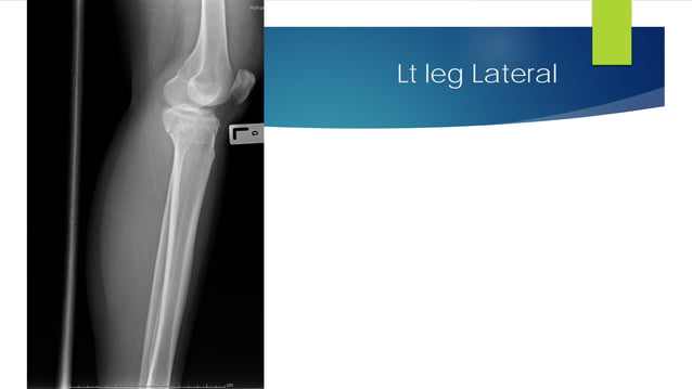 Tibial plateau fracture | PDF
