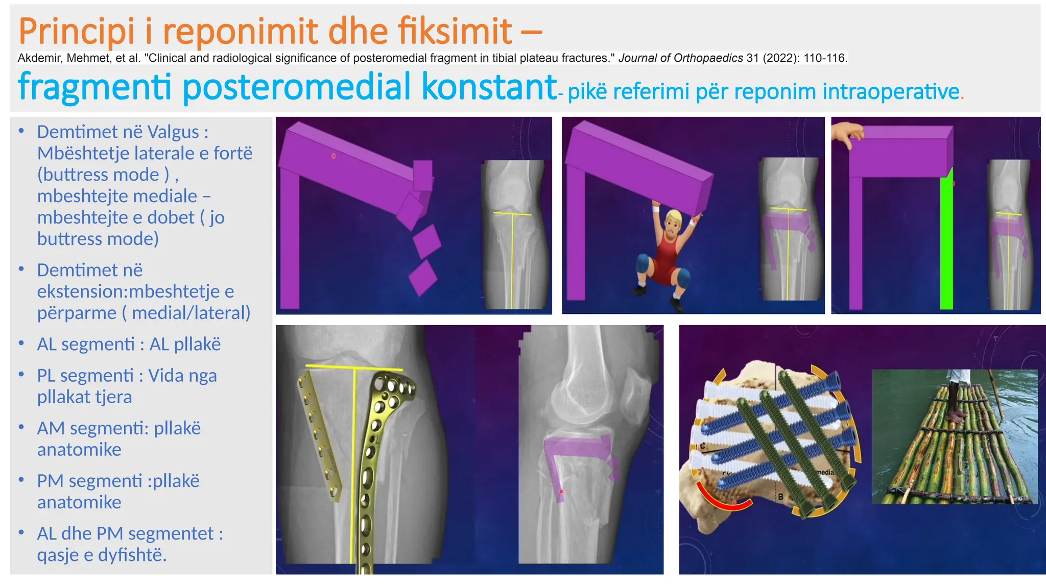 Tibial plateau fracture. Frakturat e plato tibise pptx | PPT