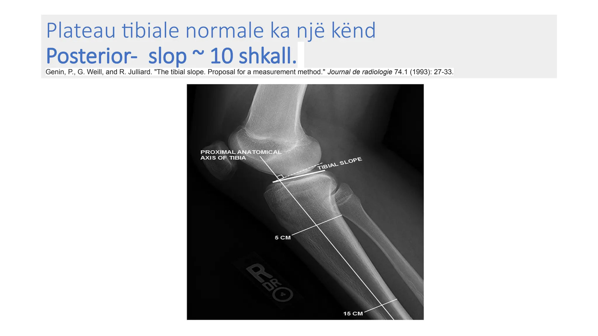 Tibial plateau fracture. Frakturat e plato tibise pptx | PPT