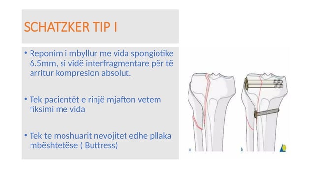 Tibial plateau fracture. Frakturat e plato tibise pptx | PPT