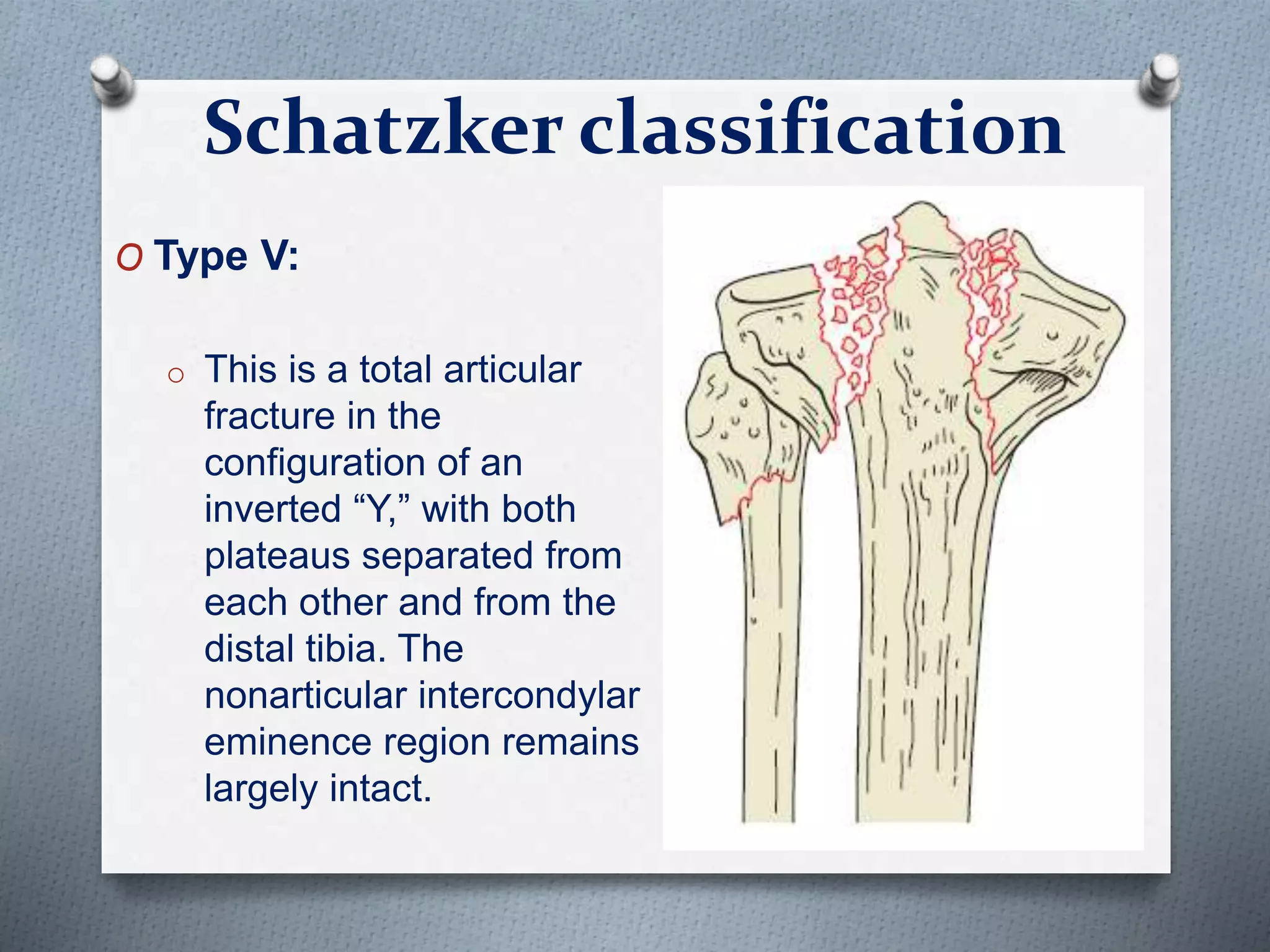 Tibial plateau fracture akeel - zuckerman | PPTX