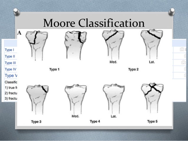 Tibial plateau fracture akeel - zuckerman