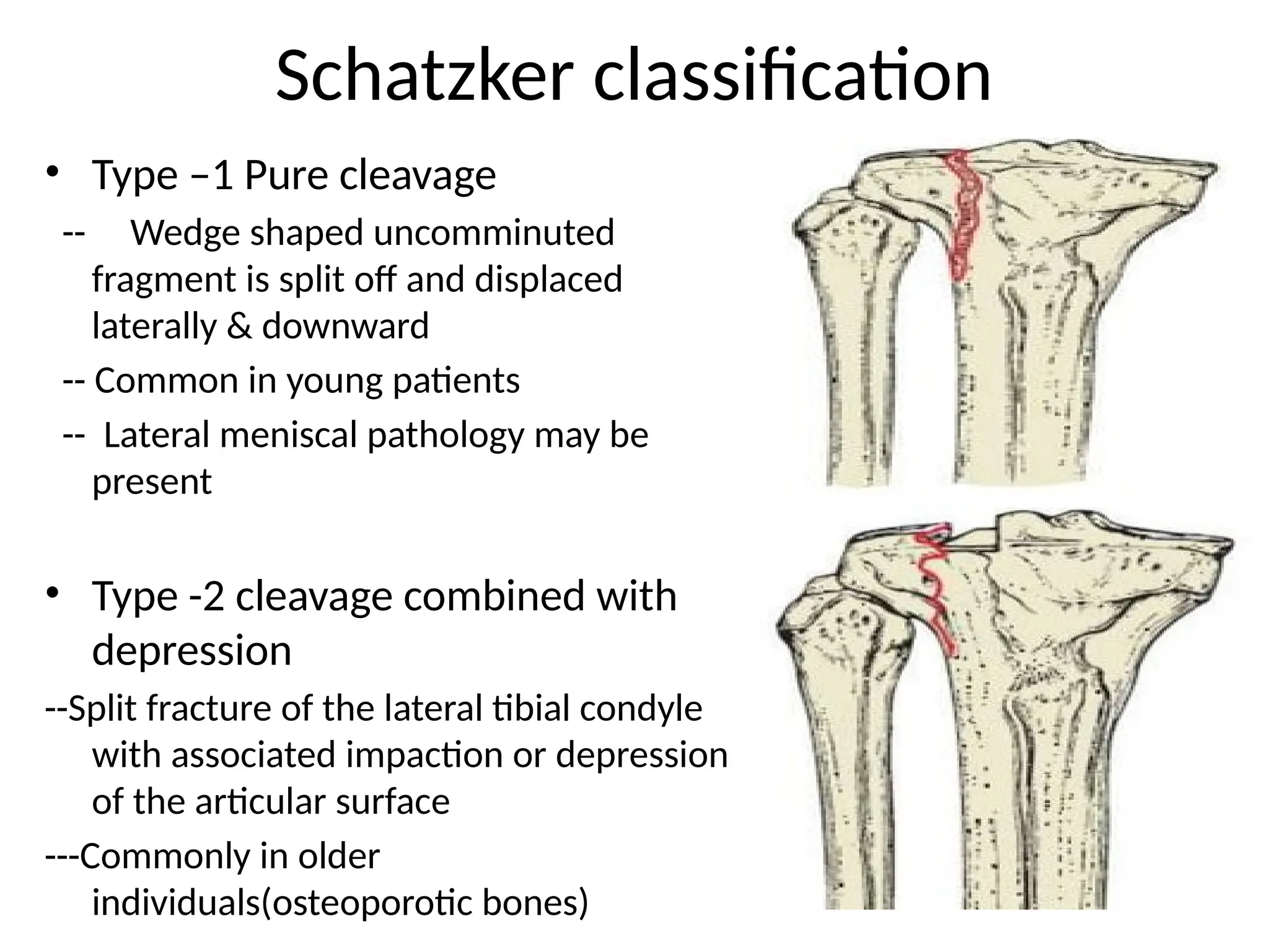 tibial plateau fracture and its management.pptx