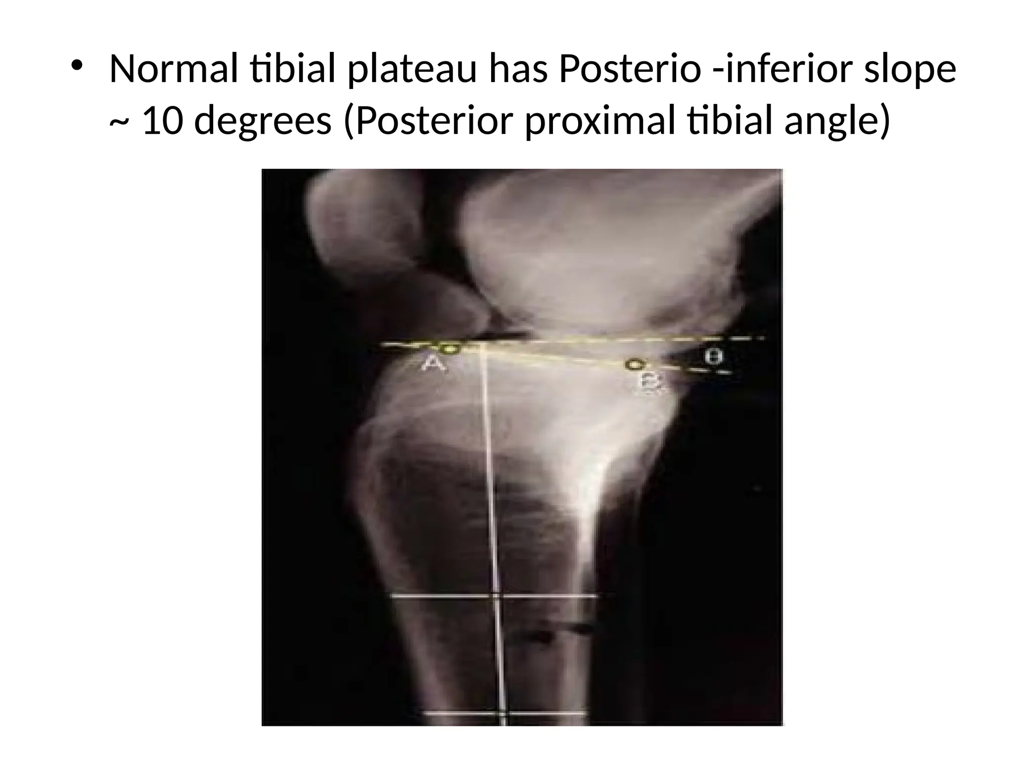 tibial plateau fracture and its management.pptx