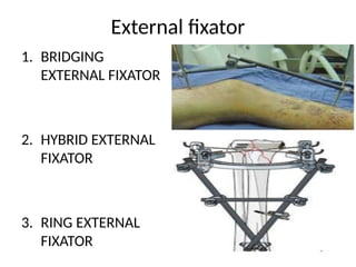 tibial plateau fracture and its management.pptx