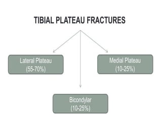 tibial plateau fracture and its management.pptx