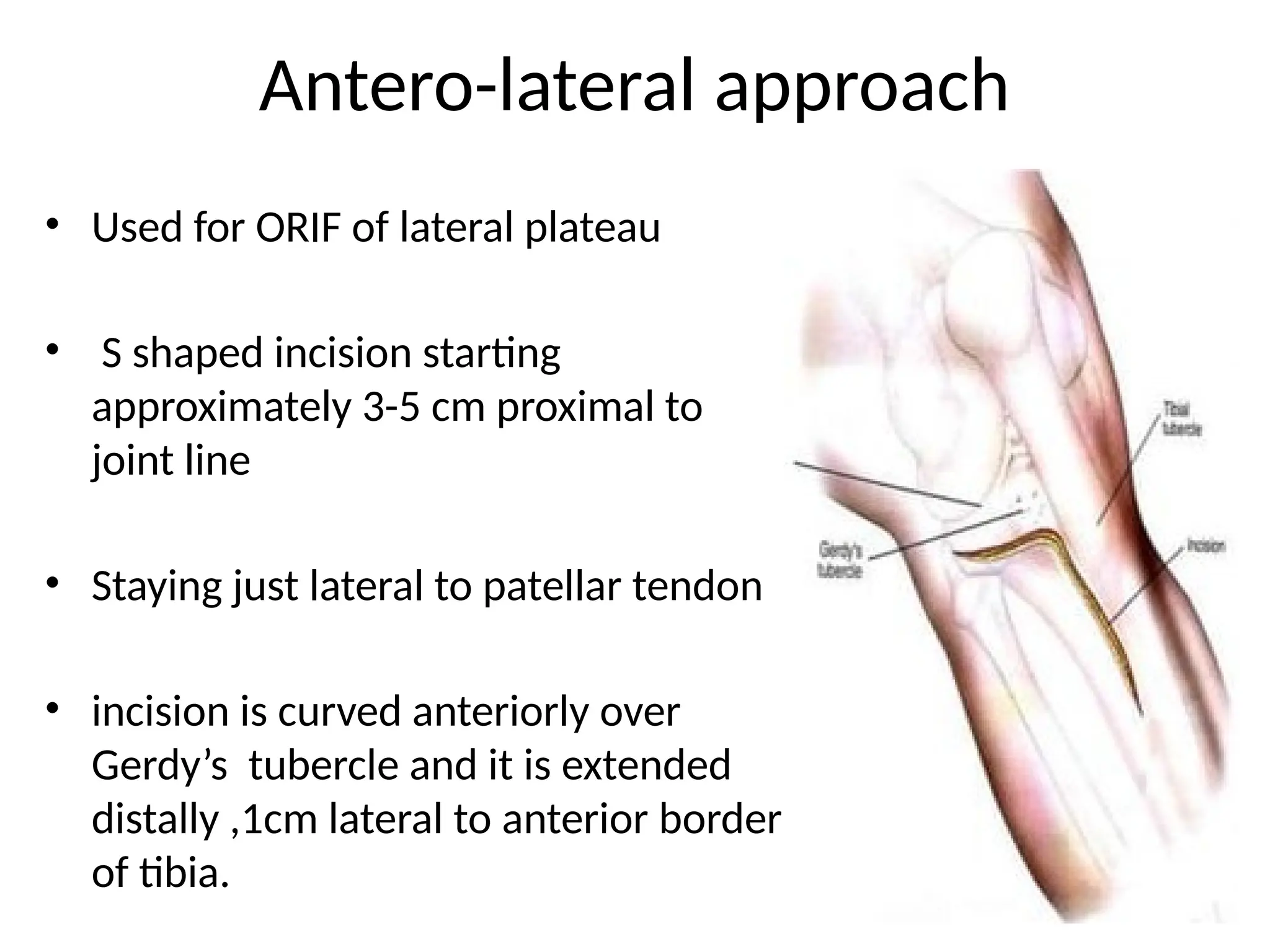 tibial plateau fracture and its management.pptx