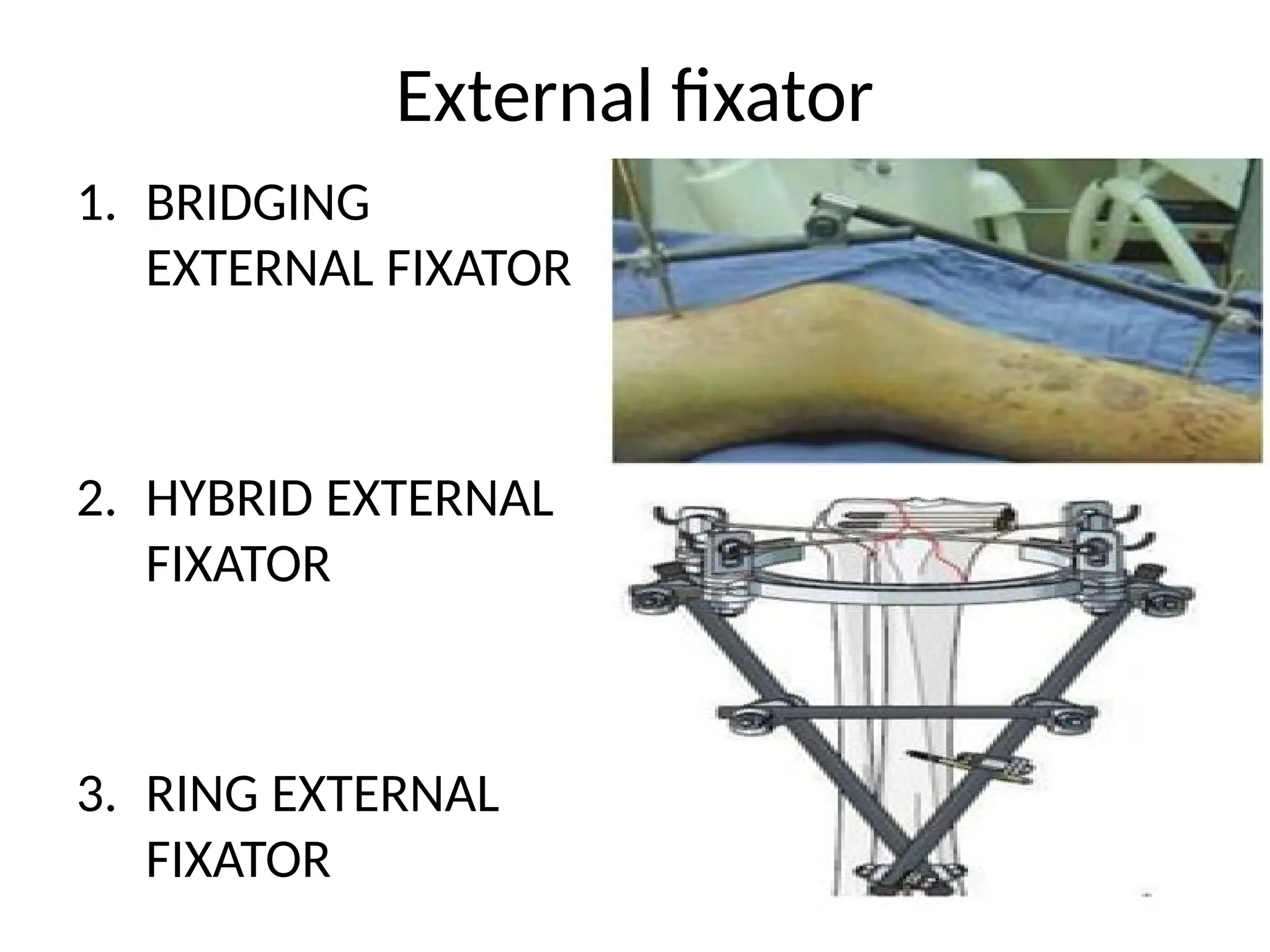 tibial plateau fracture and its management.pptx