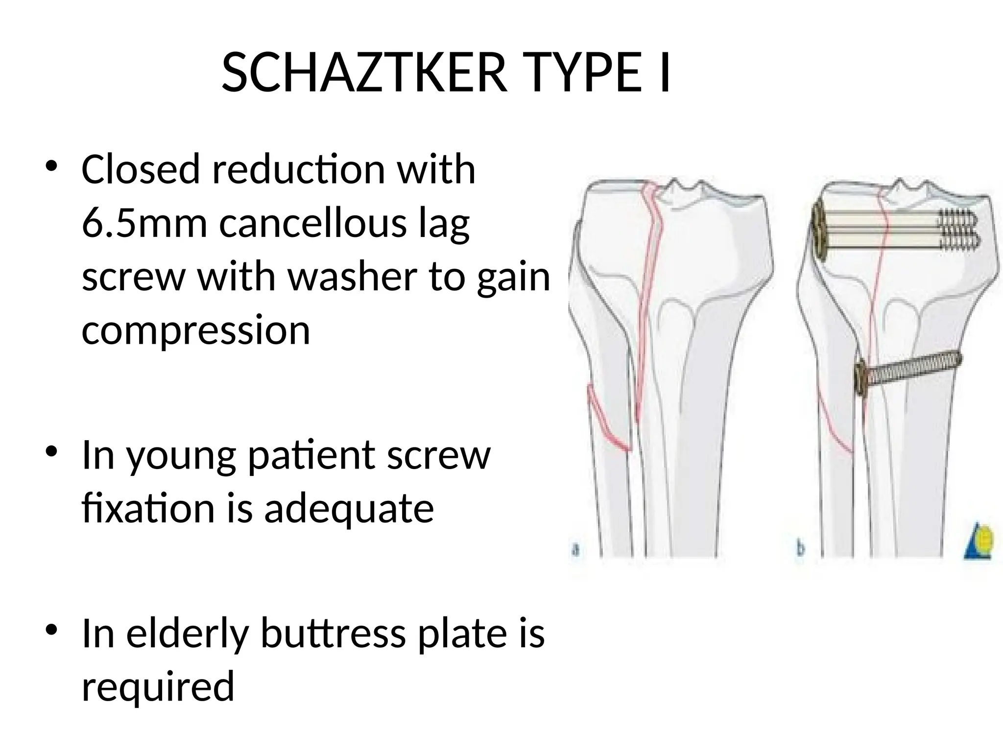 tibial plateau fracture and its management.pptx
