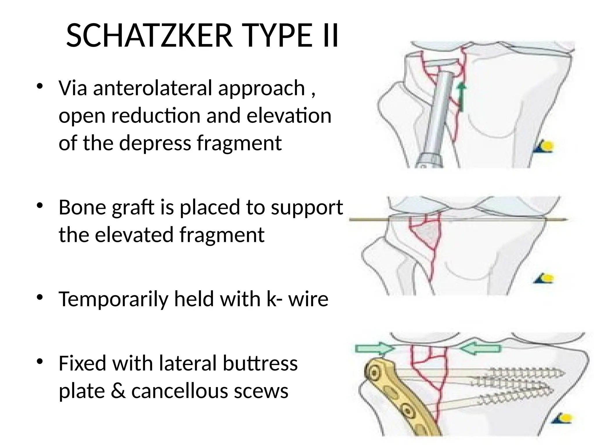 tibial plateau fracture and its management.pptx
